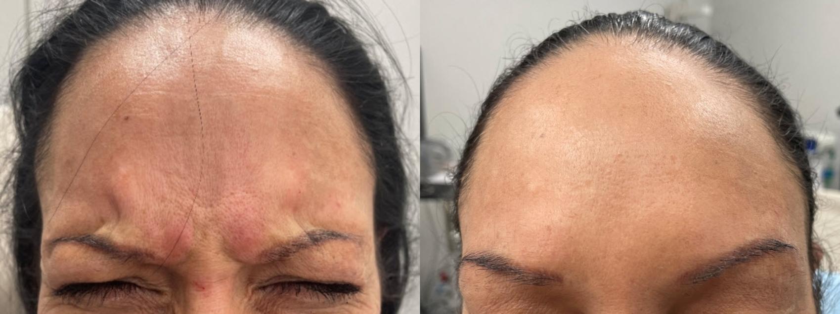 BOTOX® Cosmetic and Dysport® Before & After Photos Patient 344 | San ...