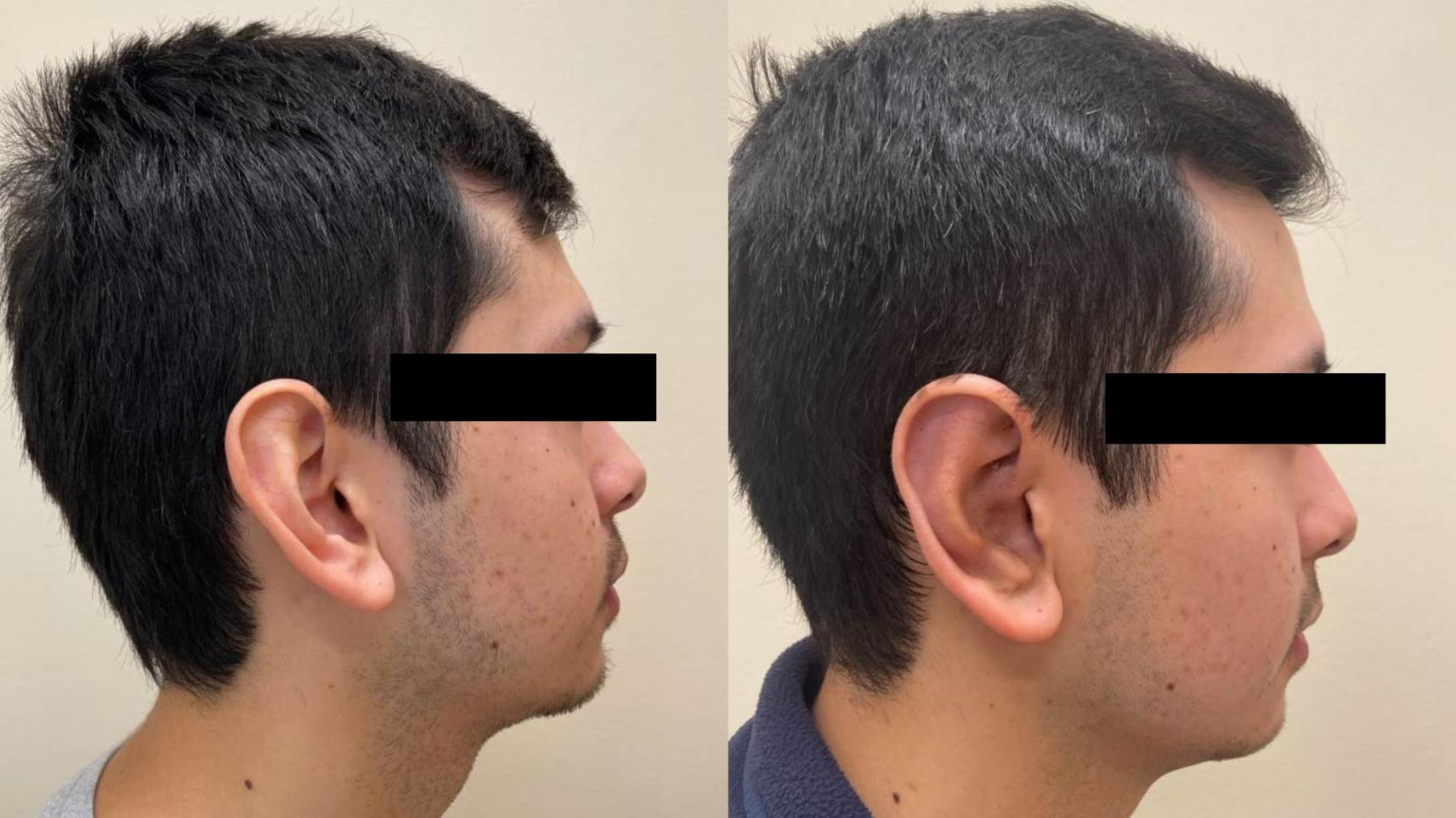 Ear Surgery Before & After Photos Patient 341 | San Francisco, CA ...