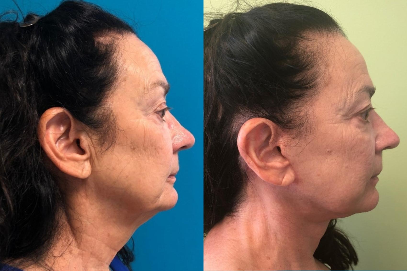 Eyelid Surgery Before & After Photos Patient 274 | San Francisco, CA ...