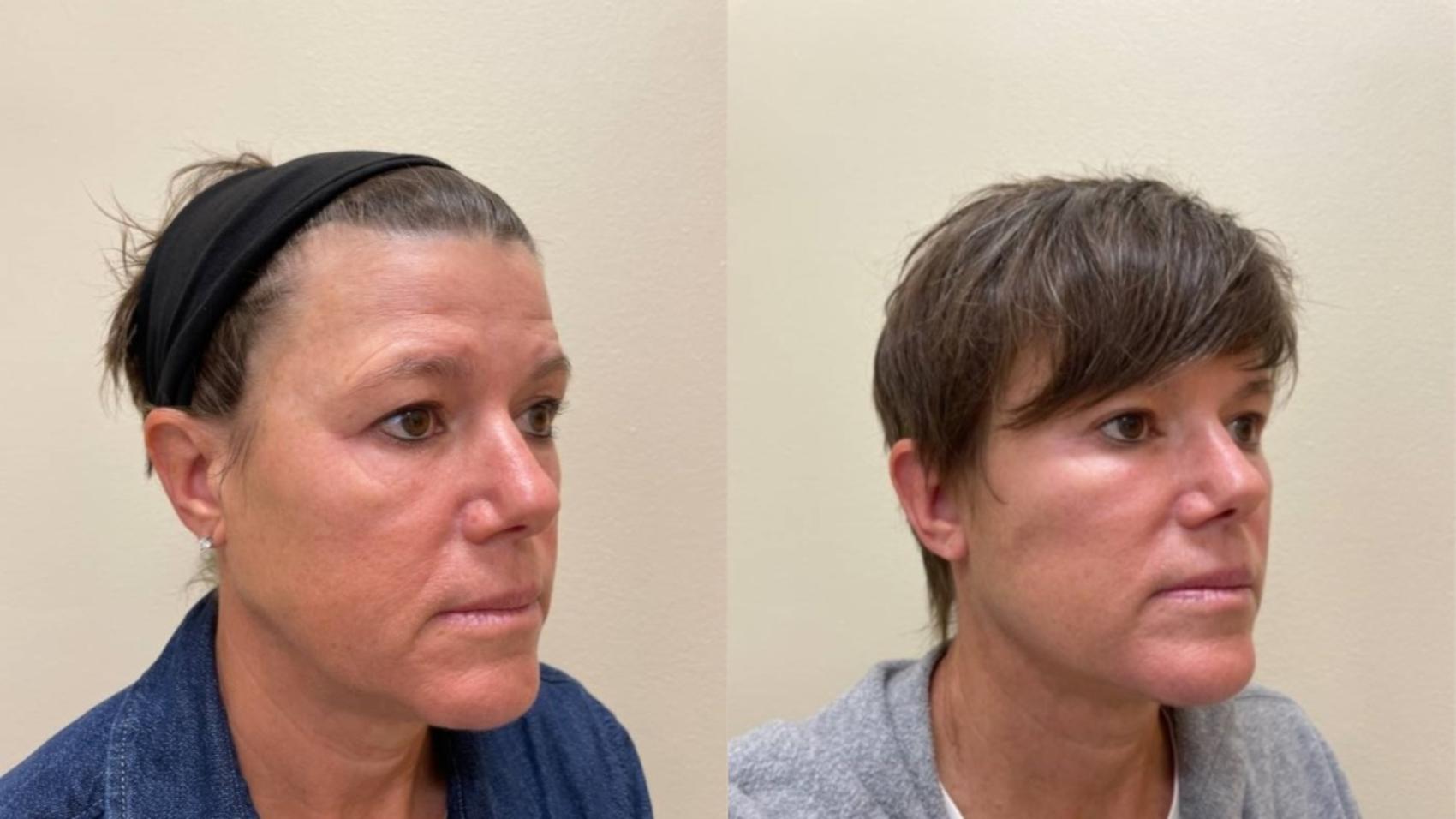 Facelift Before & After Photos Patient 343 | San Francisco, CA | Kaiser ...