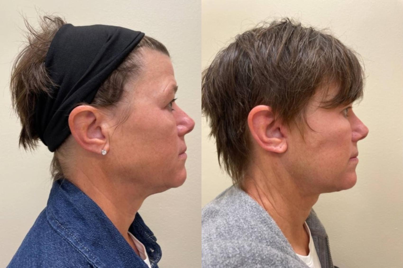 Facelift Before & After Photos Patient 343 | San Francisco, CA | Kaiser ...