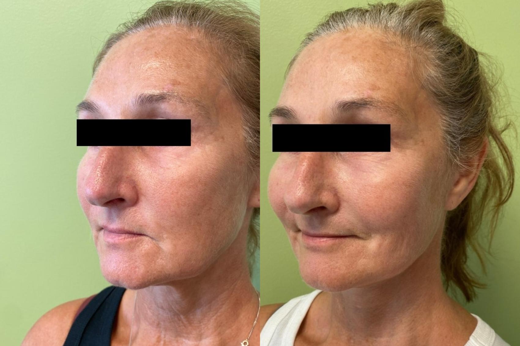 Neck Lift Before & After Photos Patient 318 | San Francisco, CA ...