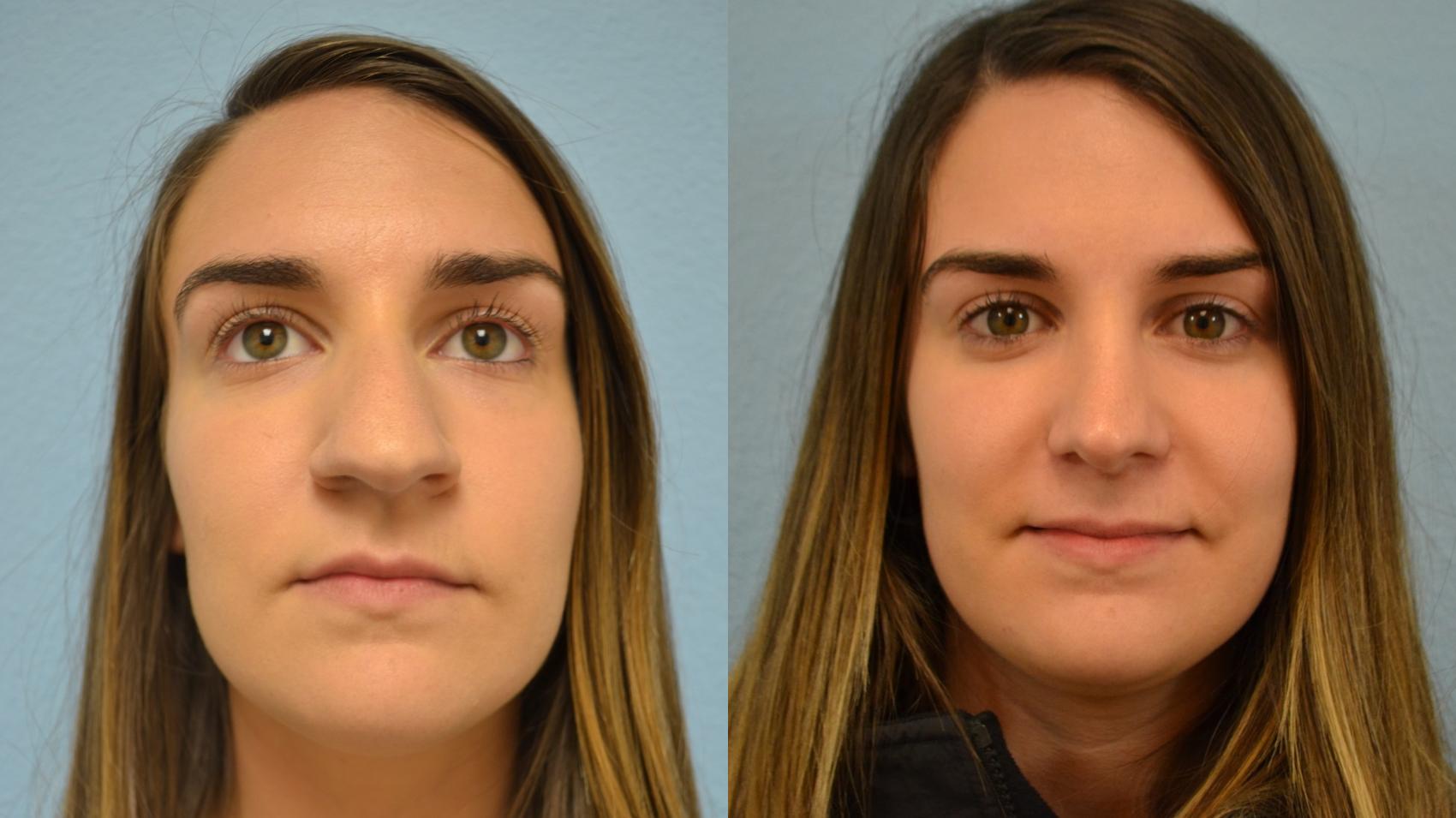 Nose Surgery Before After Photos Patient 160 San Francisco CA Nose Surgery Before After Photos Patient 160 San Francisco CA