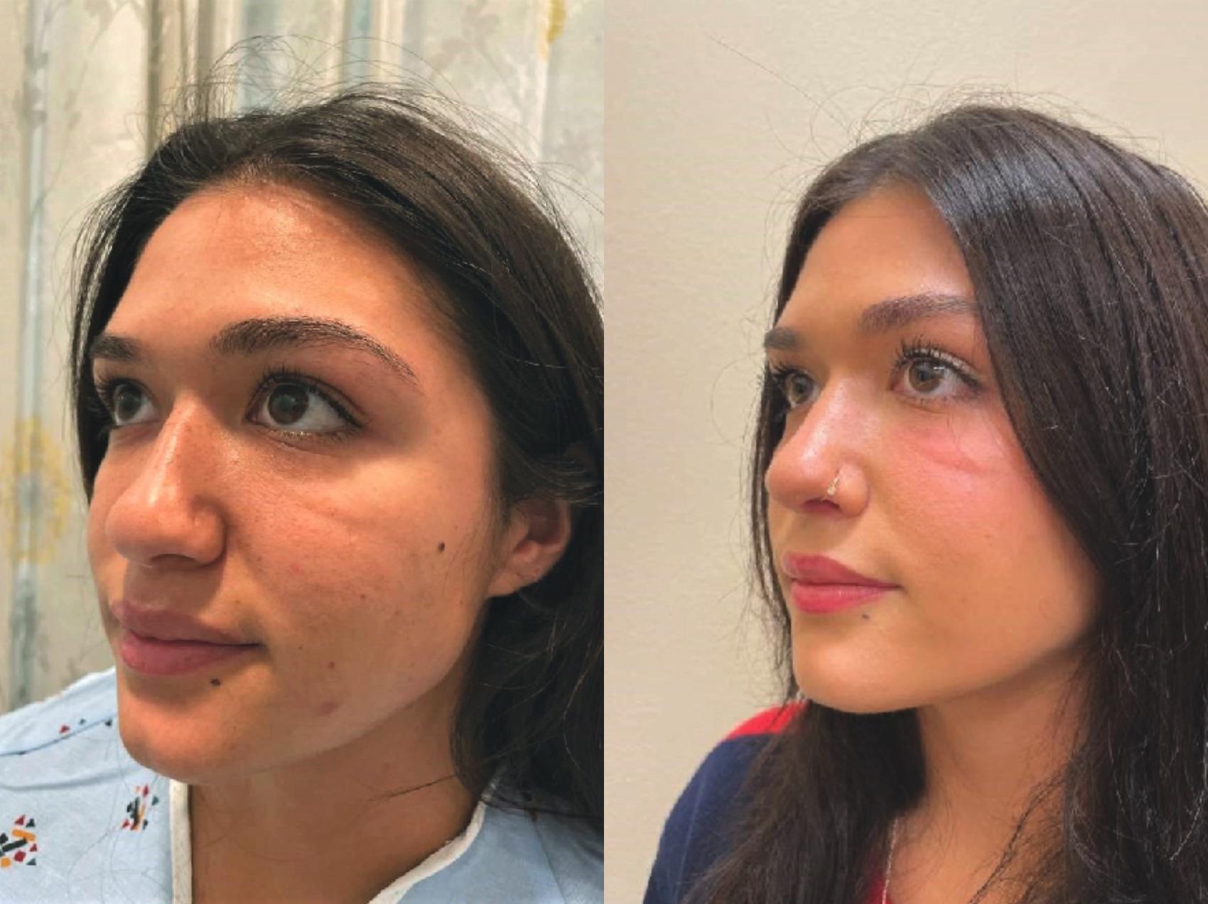 Nose Surgery Before & After Photos Patient 320 | San Francisco, CA ...