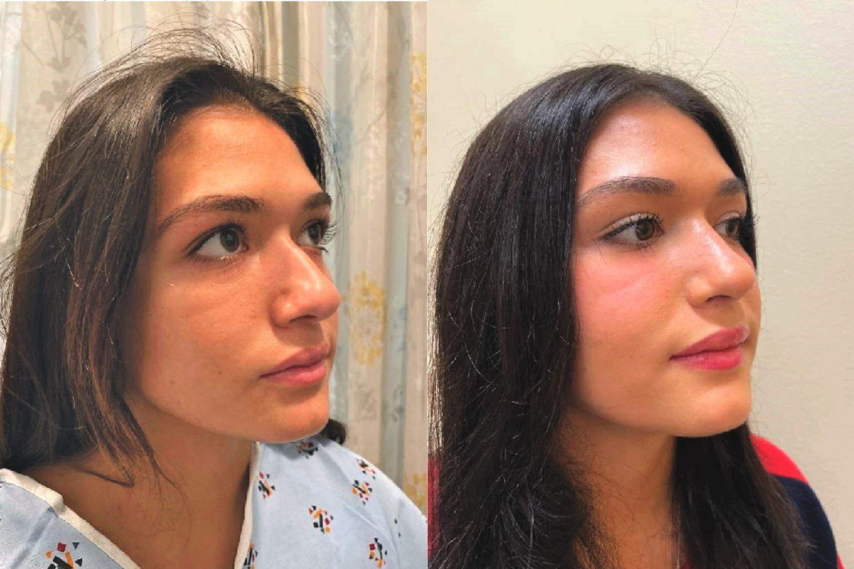 Nose Surgery Before & After Photos Patient 320 | San Francisco, CA ...