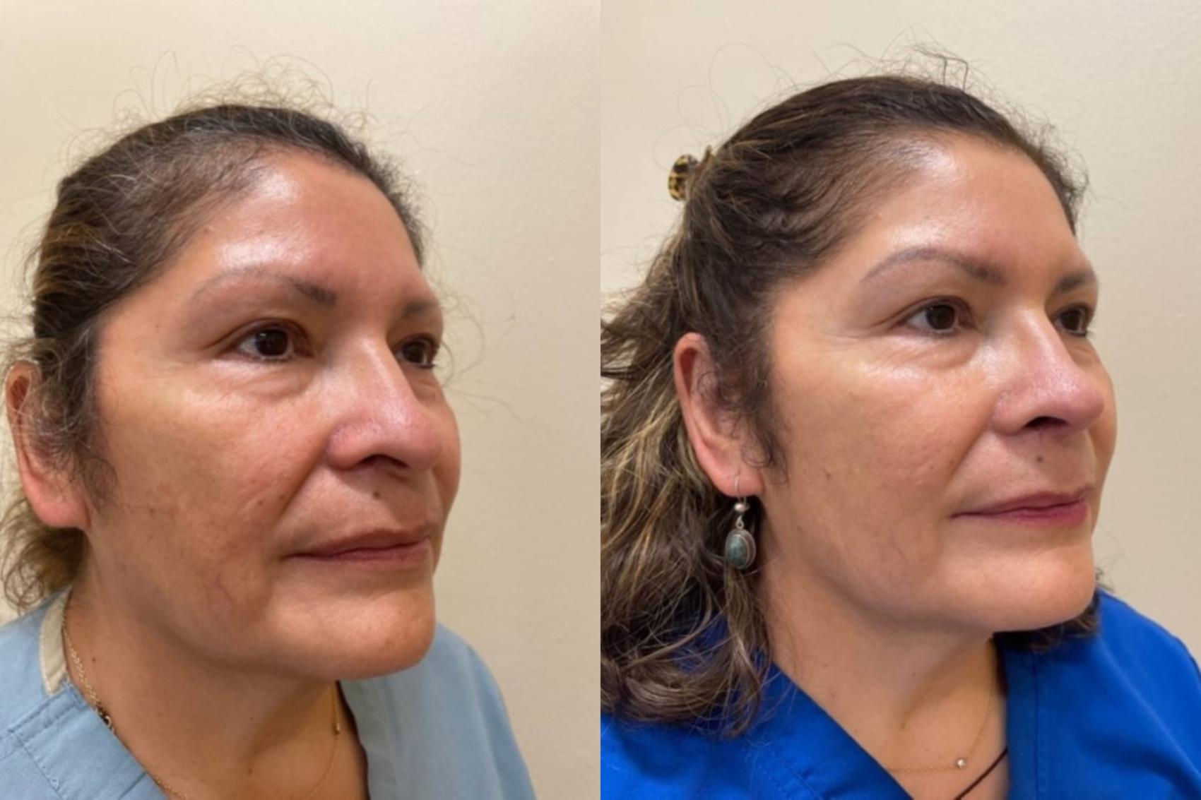 Nose Surgery Before & After Photos Patient 329 | San Francisco, CA ...