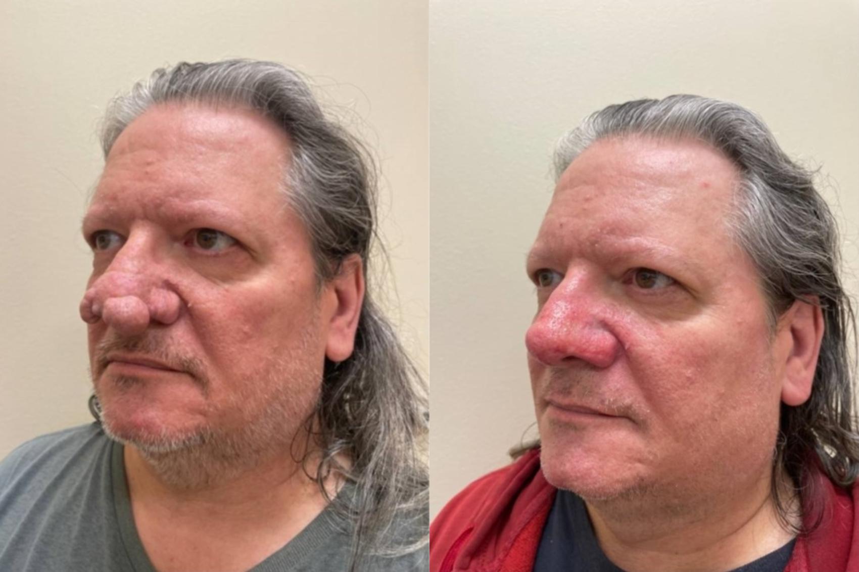 Nose Surgery Before & After Photos Patient 342 | San Francisco, CA ...