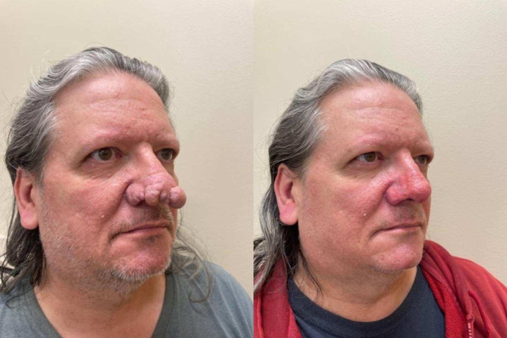 Nose Surgery Before & After Photos Patient 342 | San Francisco, CA ...