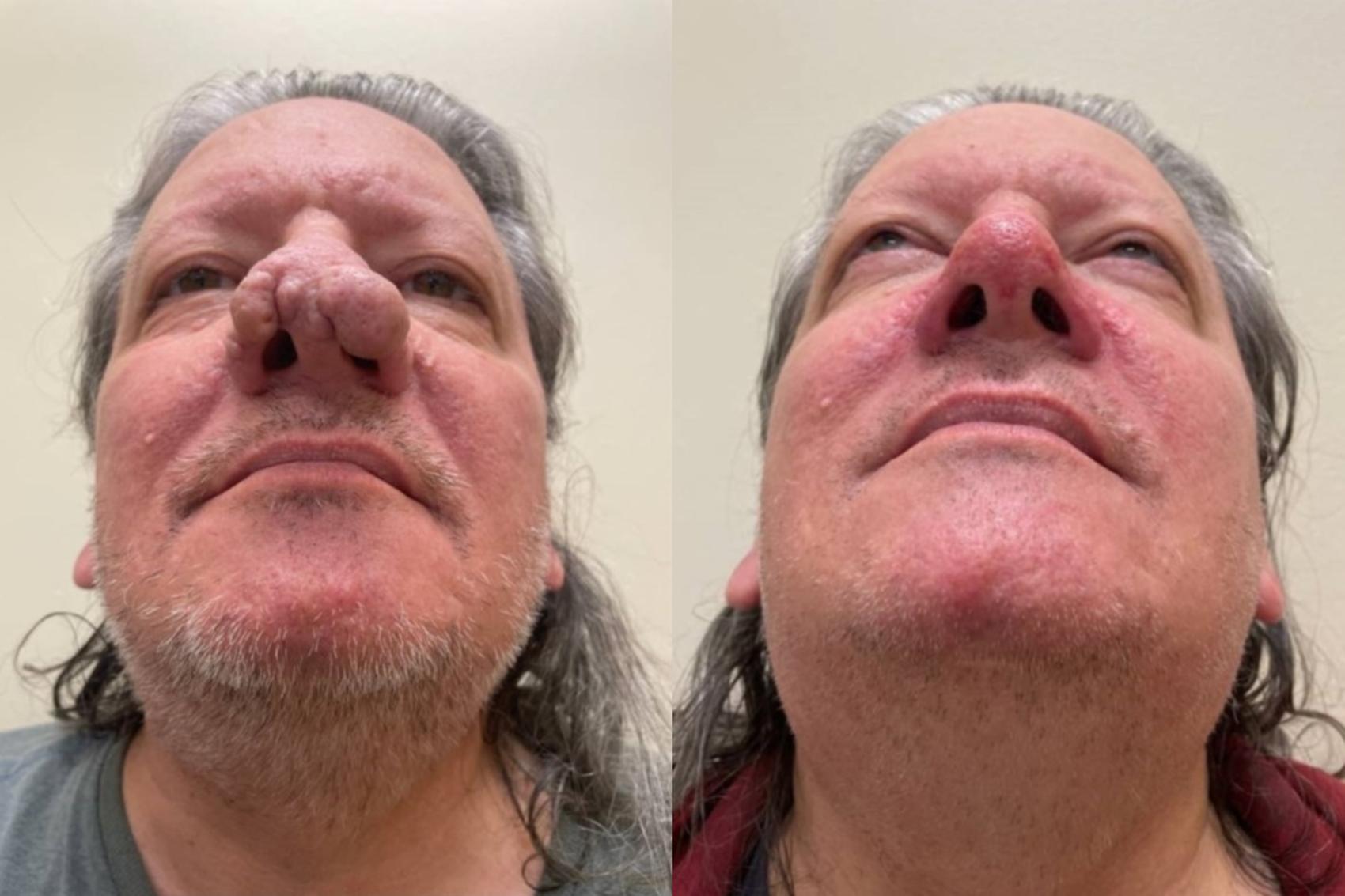 Nose Surgery Before & After Photos Patient 342 | San Francisco, CA ...