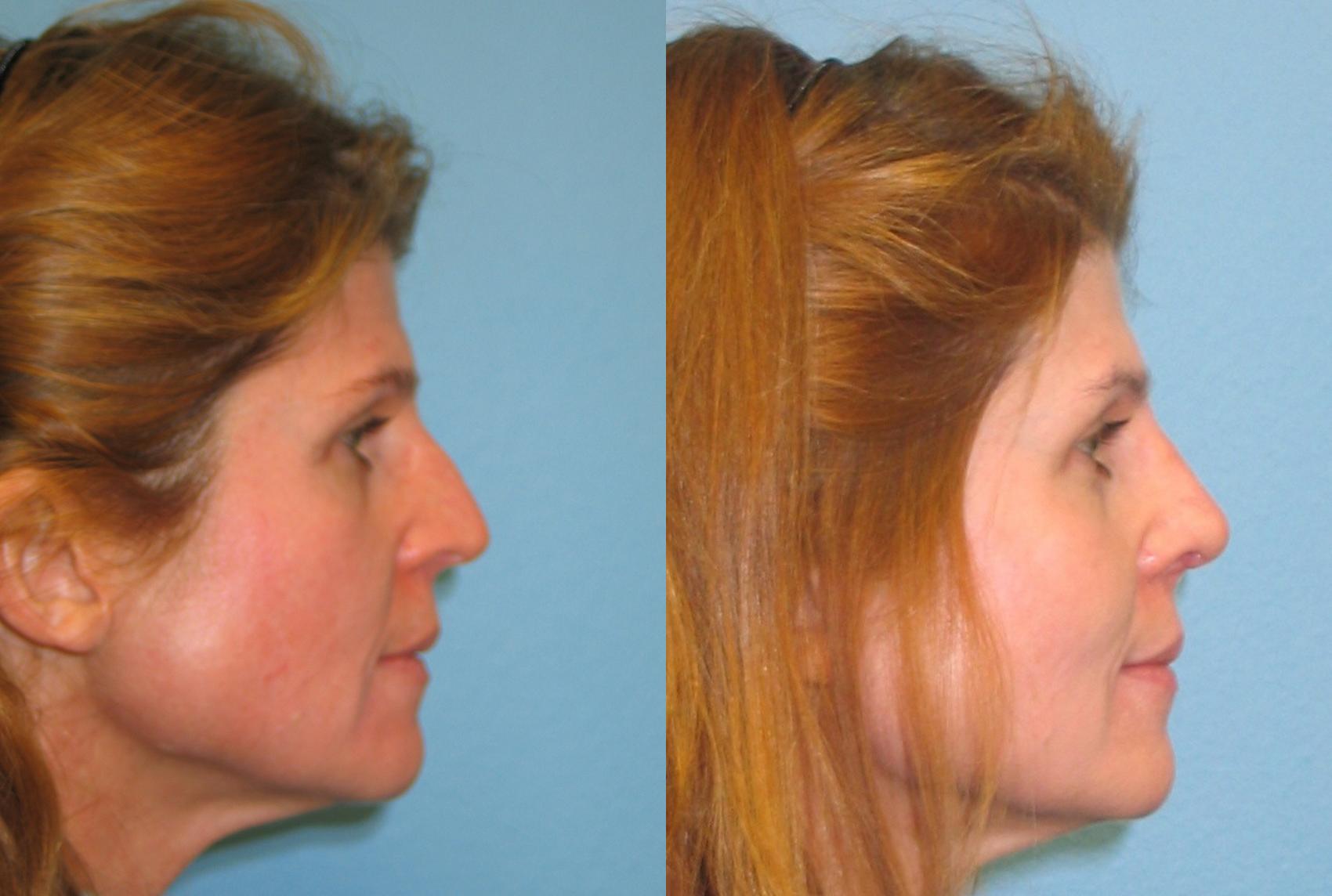 Nose Surgery Before & After Photos Patient 40 | San Francisco, CA ...